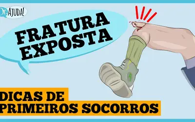 Fratura exposta: dicas de primeiros socorros | Click Nova Olímpia